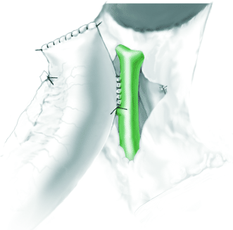 Choledochojejunostomy and Cholecystojejunostomy | SpringerLink