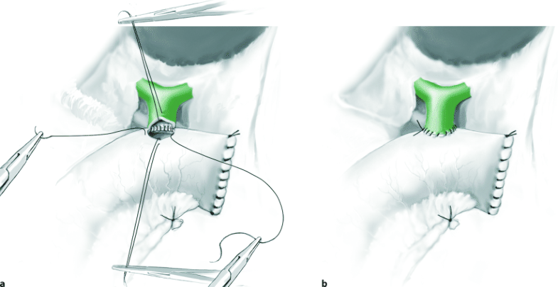 Choledochojejunostomy and Cholecystojejunostomy | SpringerLink