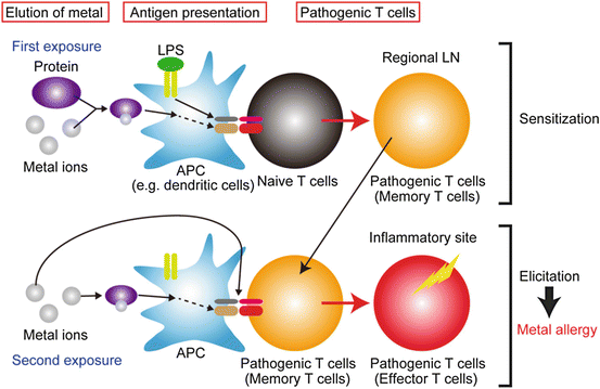 Pathological Analysis of Metal Allergy to Metallic Materials | SpringerLink