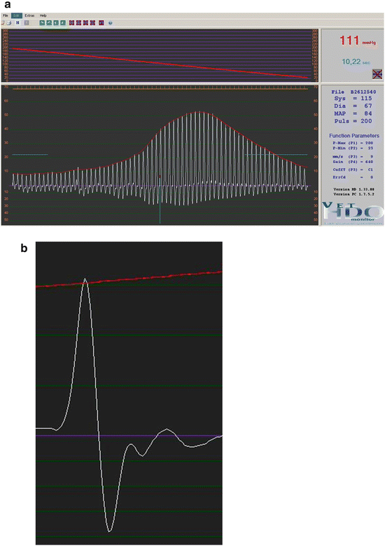 High Definition Oscillometry: Non-invasive Blood Pressure Measurement ...