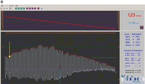 High Definition Oscillometry: Non-invasive Blood Pressure Measurement ...