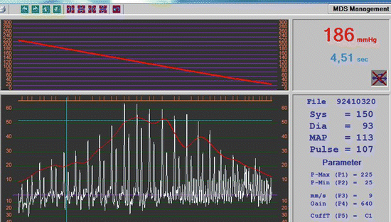 High Definition Oscillometry: Non-invasive Blood Pressure Measurement ...