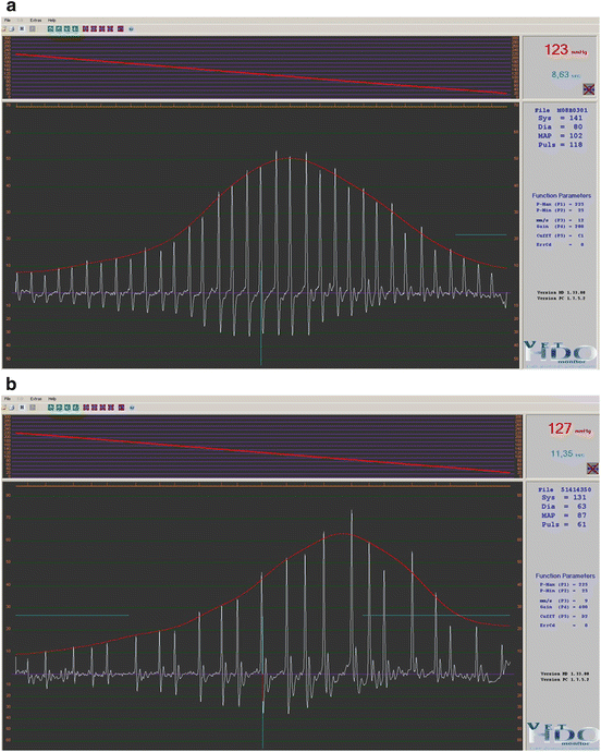 High Definition Oscillometry: Non-invasive Blood Pressure Measurement ...