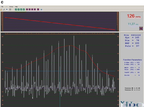High Definition Oscillometry: Non-invasive Blood Pressure Measurement ...