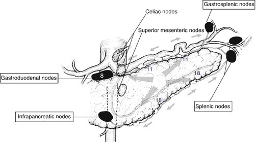 Radical Antegrade Modular Pancreato-splenectomy (RAMPS) | SpringerLink
