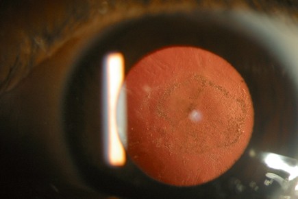 Der Graue Star = die Katarakt | SpringerLink