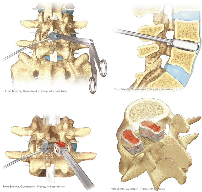 Instrumented PLIF in Lumbar Degenerative Spine: Principles, Indications ...