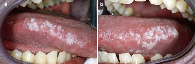 Diseases of the Tongue | SpringerLink