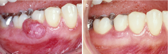 Diseases of the Gingiva and the Alveolar Mucosa | SpringerLink