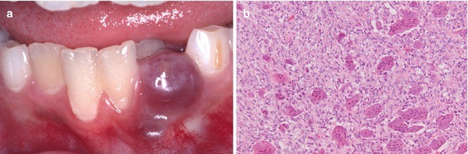 Diseases of the Gingiva and the Alveolar Mucosa | SpringerLink