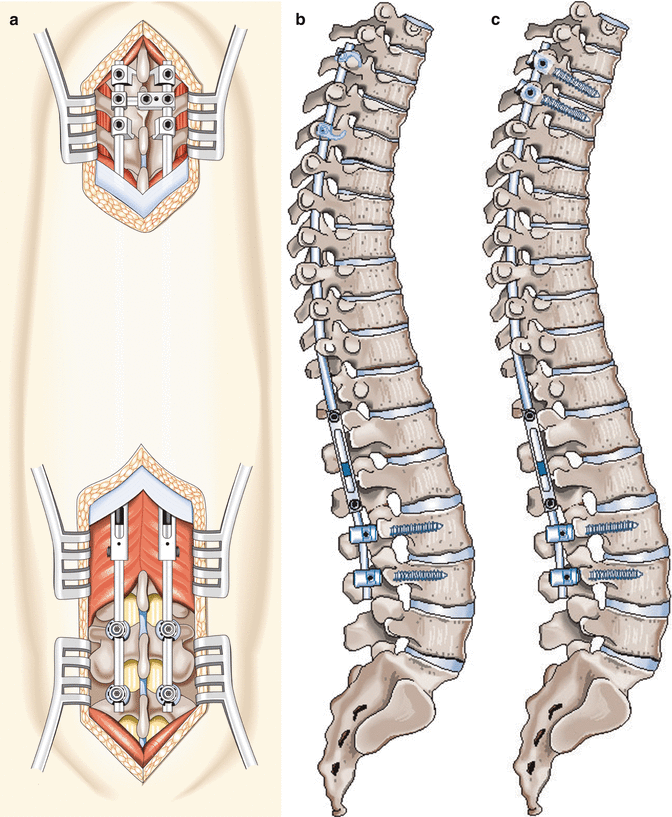 Single and Dual Traditional Growing Rods | SpringerLink