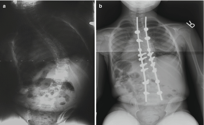 Growth-Guided Instrumentation: Shilla Procedure | SpringerLink