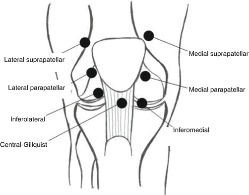 Knee Arthroscopy: General Setup, Portal Options, and How to Manage a ...