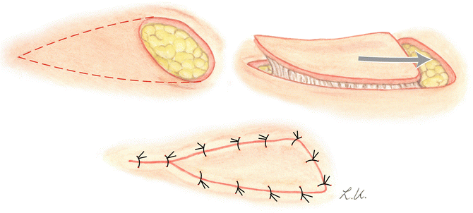 Operative Dermatologie | SpringerLink