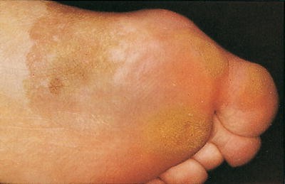 Mykosen | SpringerLink