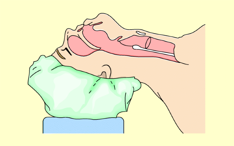 Endotracheale Intubation, Larynxmaske und Larynxtubus | SpringerLink