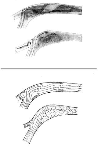 Arteriovenöse Interponate | SpringerLink