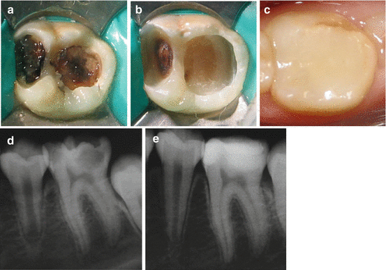 Vital Pulp Therapy for Permanent Molars | SpringerLink