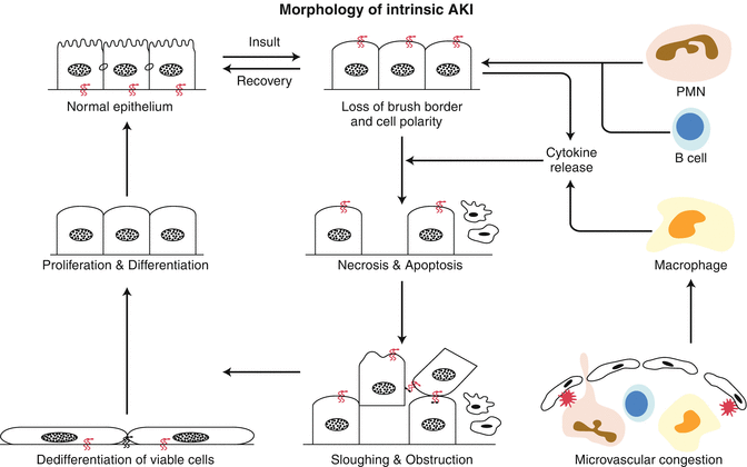 Acute Kidney Injury: Prevention and Diagnosis | SpringerLink
