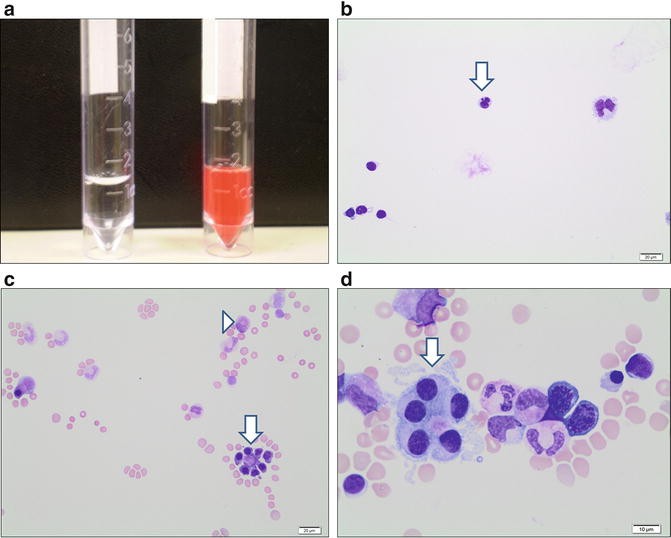 CSF and CNS Cytology | SpringerLink