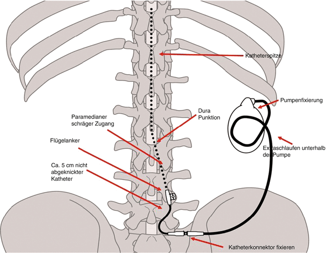 Intrathekale Medikamentengabe durch implantierbare Pumpen | SpringerLink