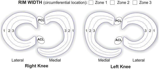 Classification of Meniscal Tears | SpringerLink