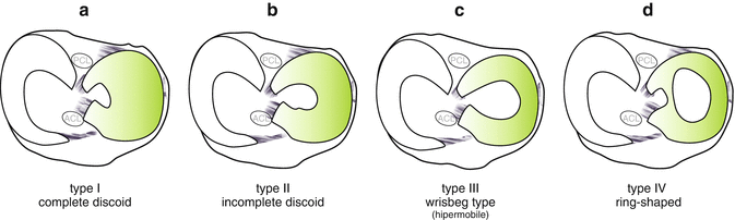Classification of Meniscal Tears | SpringerLink