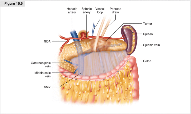 Open Distal Pancreatectomy | SpringerLink