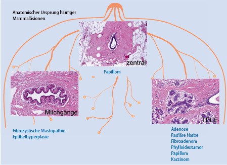 Pathologie der Mamma | SpringerLink