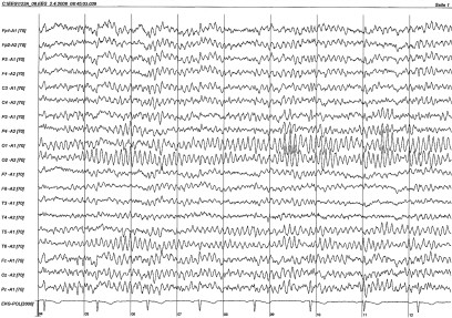 Das normale EEG | SpringerLink