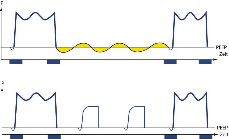 BIPAP (Biphasic Positive Airway Pressure/BiLevel/DuoPAP/BiVent ...