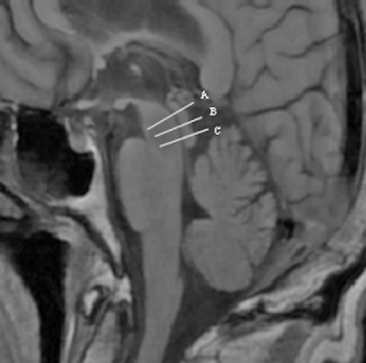 Quantification of Normal CSF Flow Through the Aqueduct Using PC-Cine ...