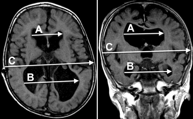 Frontal and Temporal Horn Ratio: A Valid and Reliable Index to ...