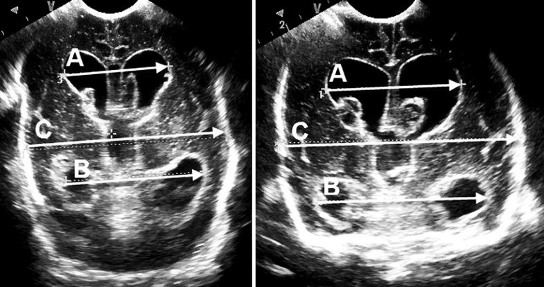 Frontal and Temporal Horn Ratio: A Valid and Reliable Index to ...