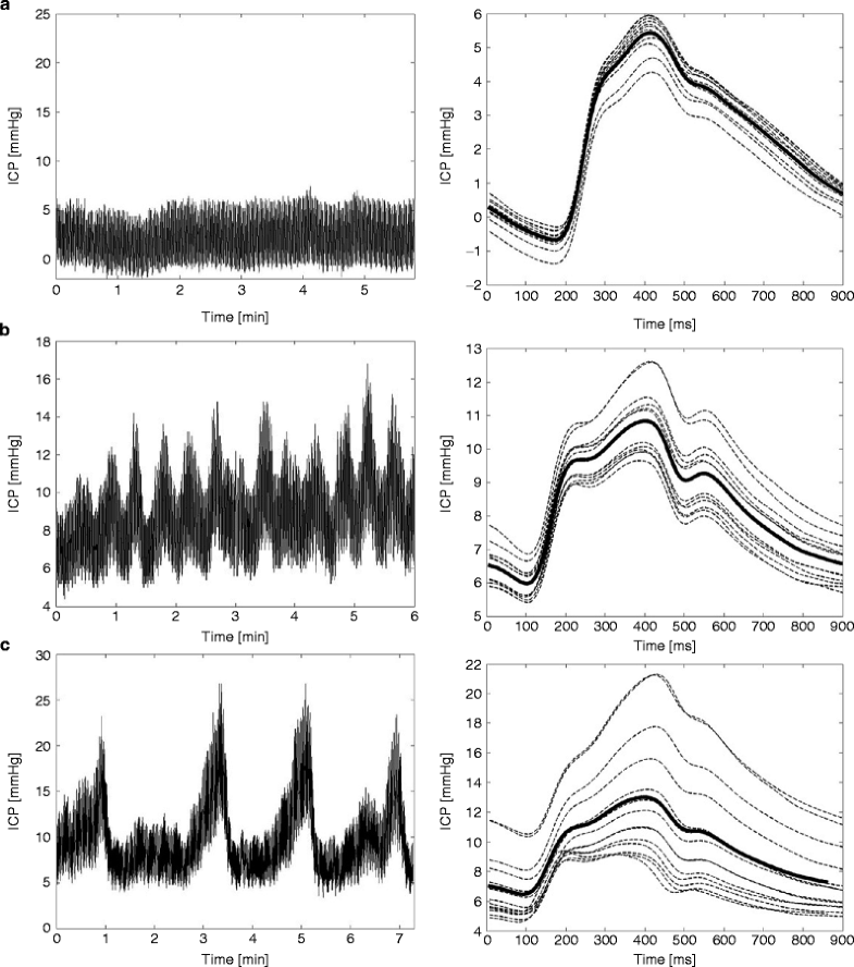 Association Between ICP Pulse Waveform Morphology and ICP B Waves ...