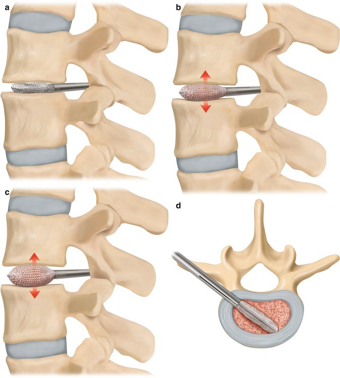 Expandable Cages for Lumbar Spinal Deformity | SpringerLink