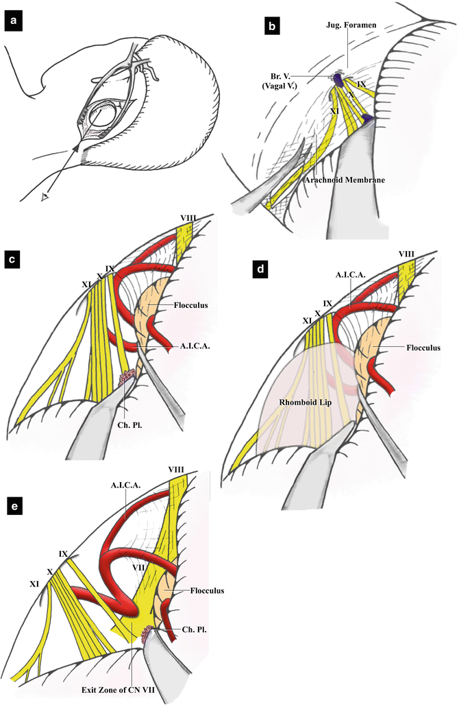 Microvascular Decompression Surgery for Hemifacial Spasm: The Lateral ...