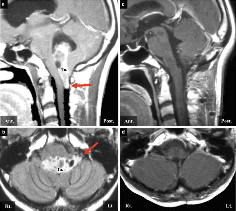 Microsurgical Anatomy of the Cerebellomedullary Fissure and Variations ...