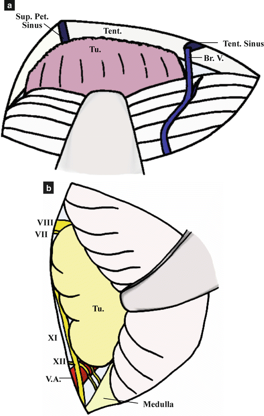 The Retrosigmoid Lateral Suboccipital Approach: Basic Approach and ...
