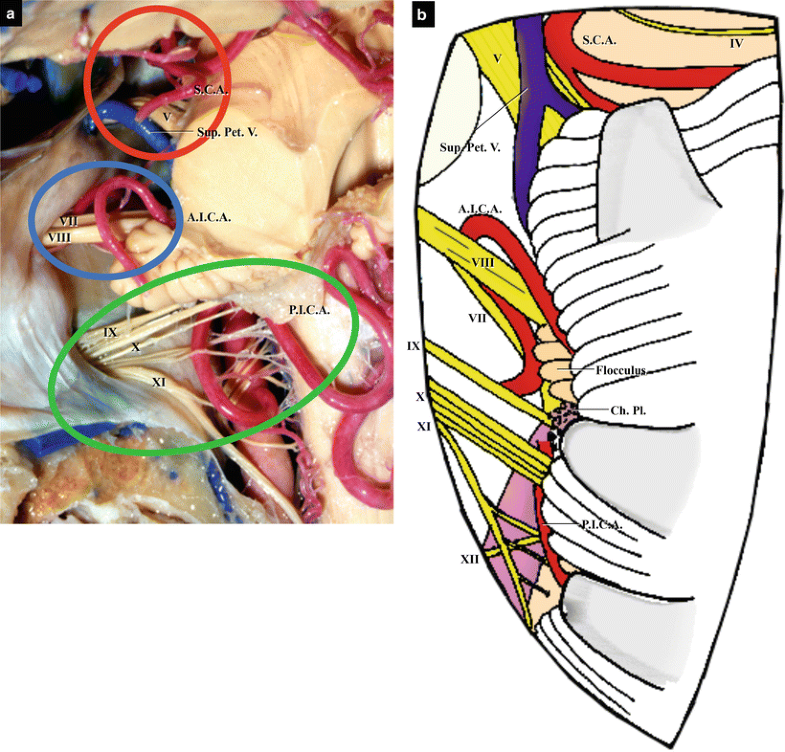 The Retrosigmoid Lateral Suboccipital Approach: Basic Approach and ...