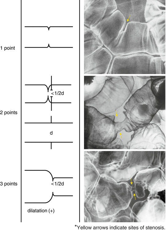 Stenotic Lesions | SpringerLink