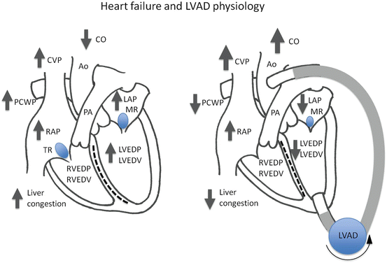 Strategies to Assess and Minimize Right Heart Failure After Left ...