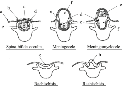 Anesthesia During Surgery for Meningomyelocele | SpringerLink