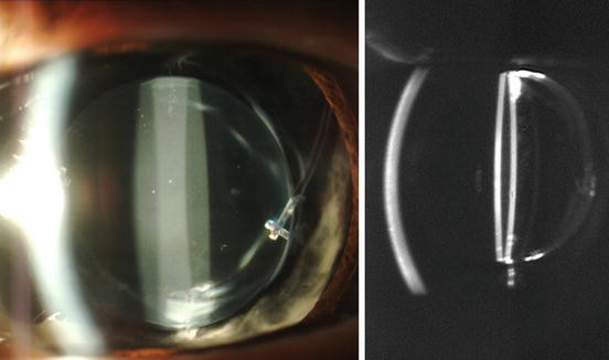 IOL Surface Light Scattering and Visual Function | SpringerLink