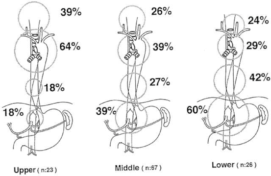 Surgery Transthoracic Esophagectomy | SpringerLink