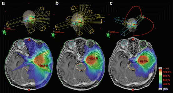 Brain Tumor: How Should We Manage Glioblastoma in the Era of IMRT ...