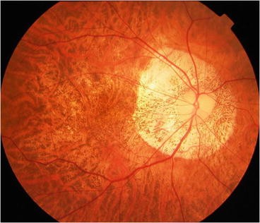 High Myopia and Myopic Glaucoma: Findings in the Peripapillary Retina ...