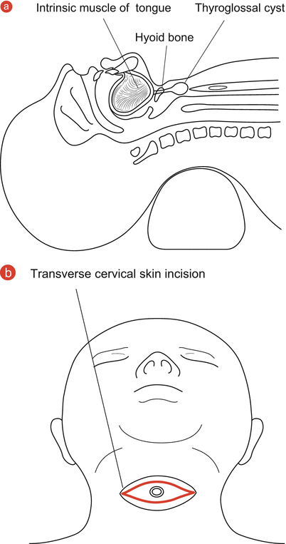 Head and Neck Sinus and Mass | SpringerLink