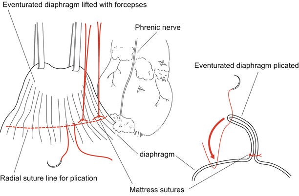 Congenital Diaphragmatic Hernia and Diaphragmatic Eventration ...