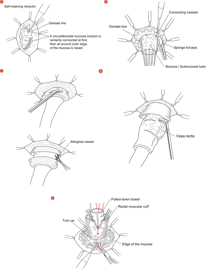 Hirschsprung’s Disease | SpringerLink